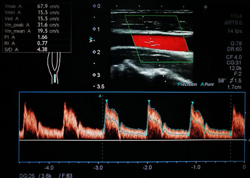 AI in Arterial Conditions - Revascular